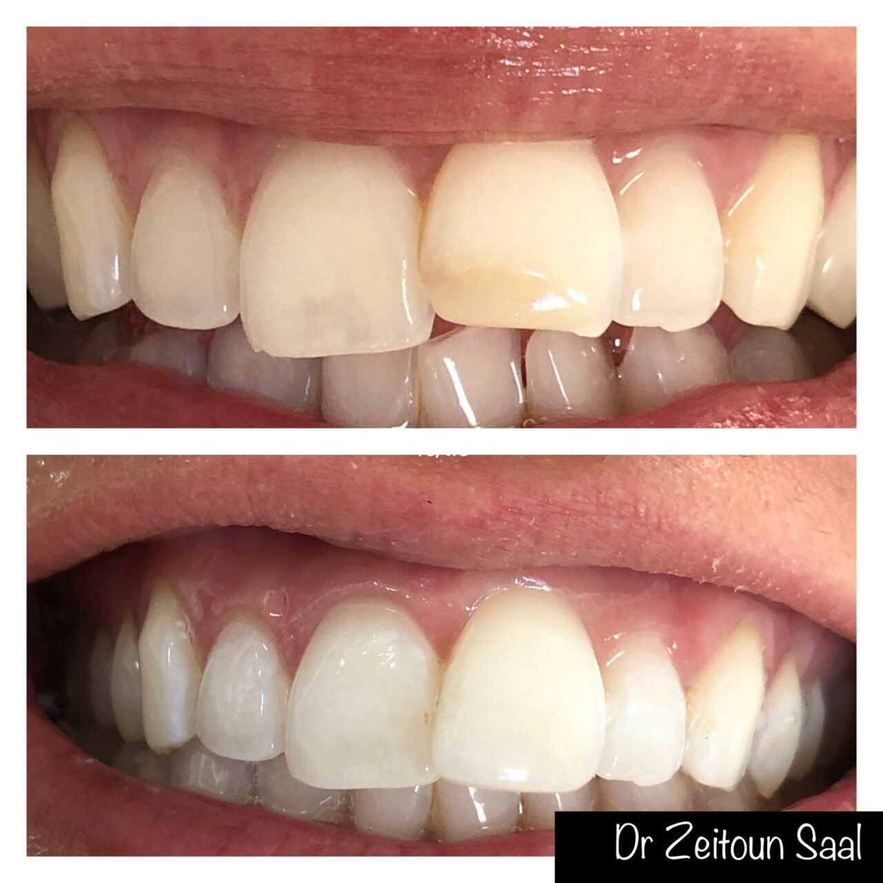 La restauration dentaire en résine composite - Dr Laura Zeitoun