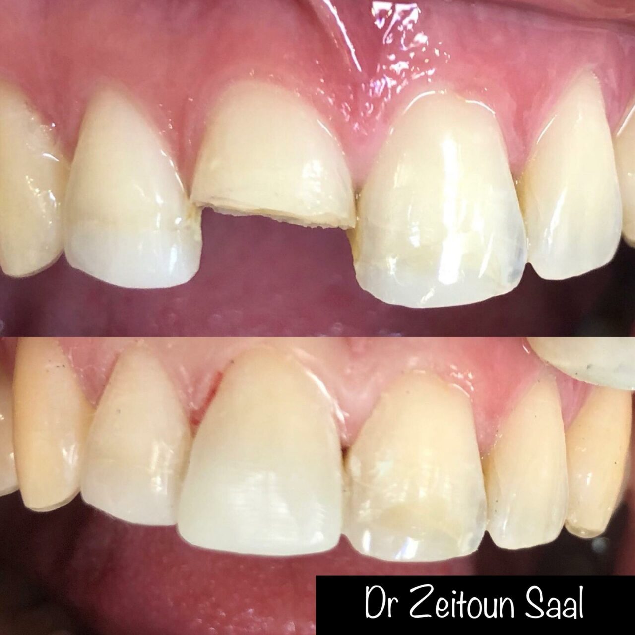 La restauration dentaire en résine composite - Dr Laura Zeitoun
