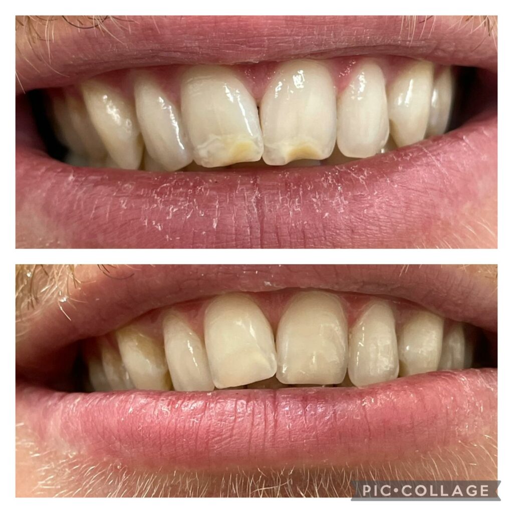 Fluorose dentaire - Dr Laura Zeitoun