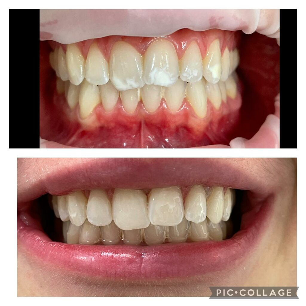 Traitement fluorose dentaire - Dr Laura Zeitoun