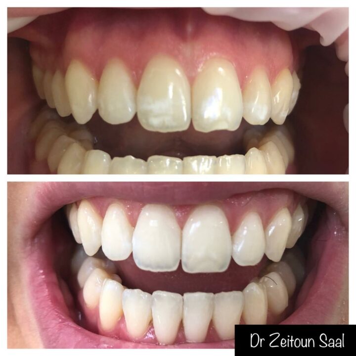 Traitement fluorose dentaire - Dr Laura Zeitoun